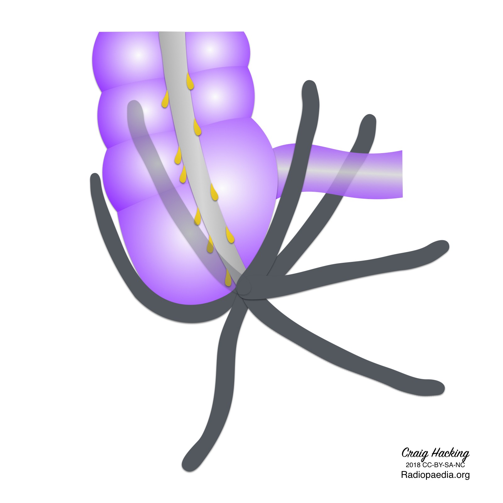 Radiopaedia - Drawing Anatomic various positions of the appendix - no ...