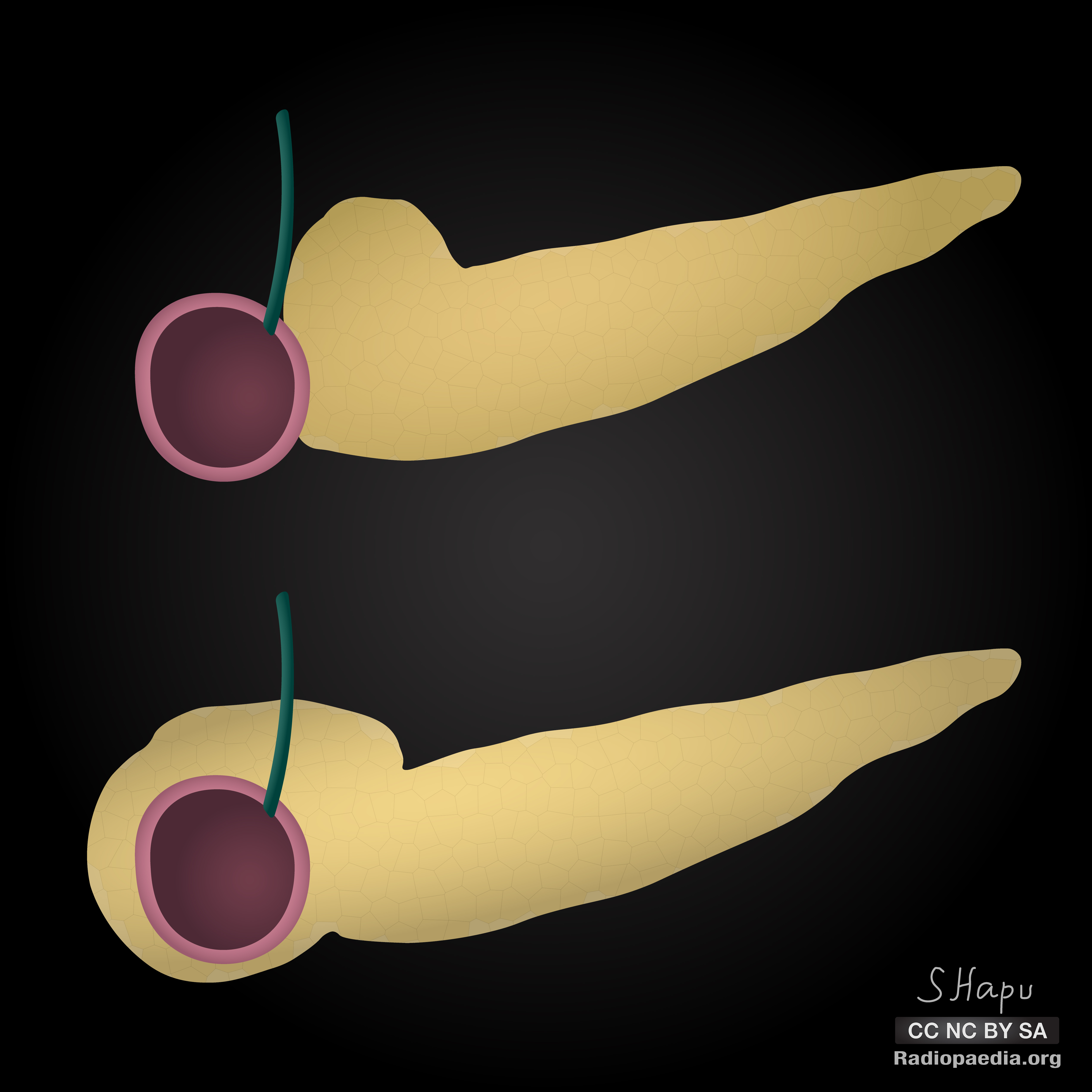 Radiopaedia - Drawing Annular pancreas - no labels | AnatomyTOOL