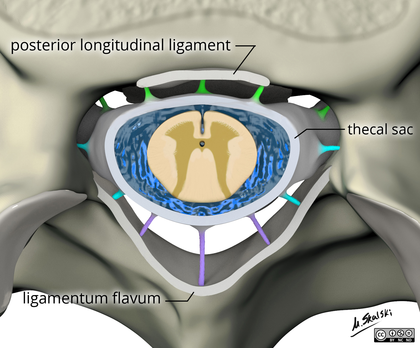 Radiopaedia - Drawing Ligamentum flavum, posterior longitudinal ...