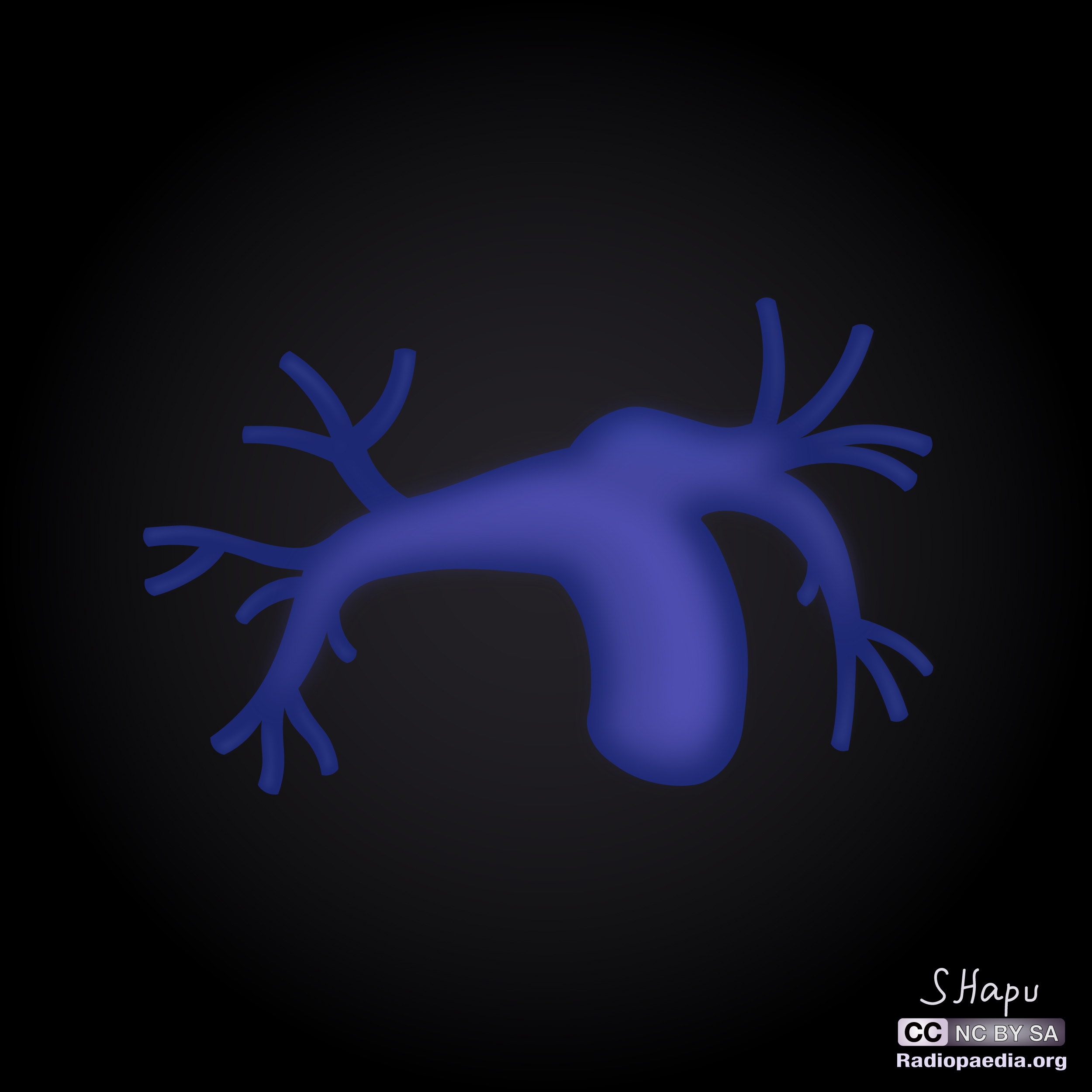 Radiopaedia - Drawing Pulmonary trunk and its branches - no labels ...