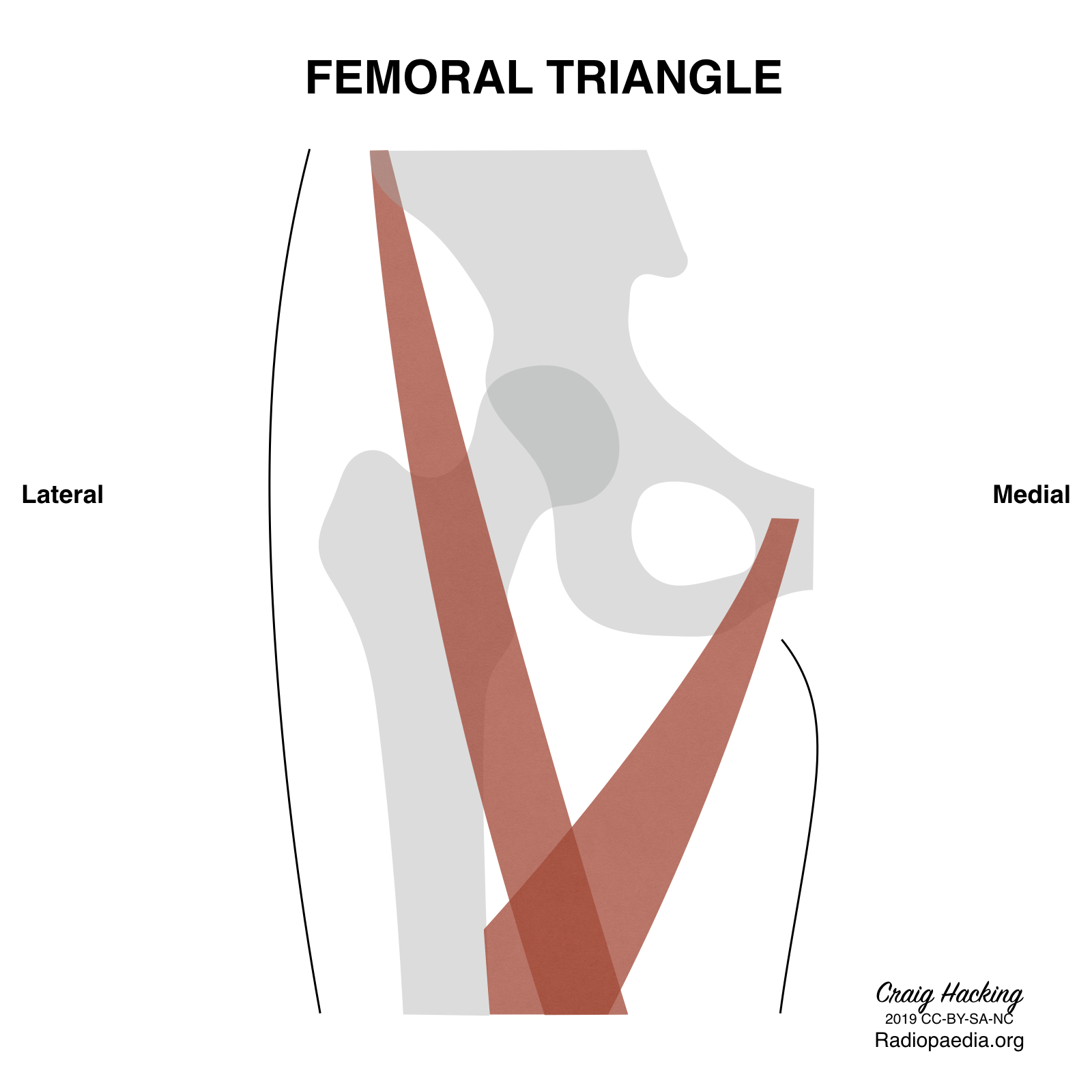 Radiopaedia - Drawing Muscle borders of the femoral triangle - no ...