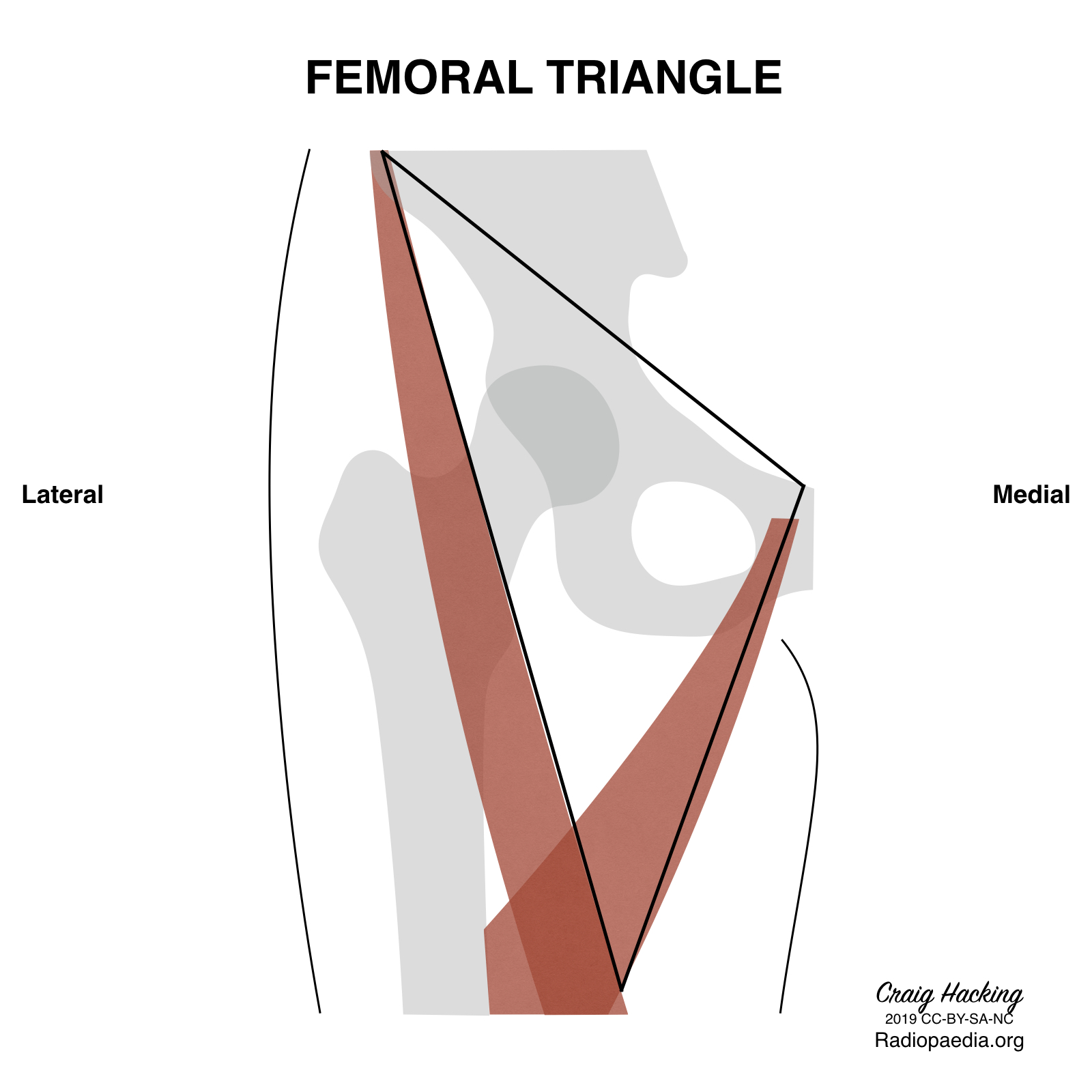 Radiopaedia - Drawing Boundaries of the femoral triangle - no labels ...