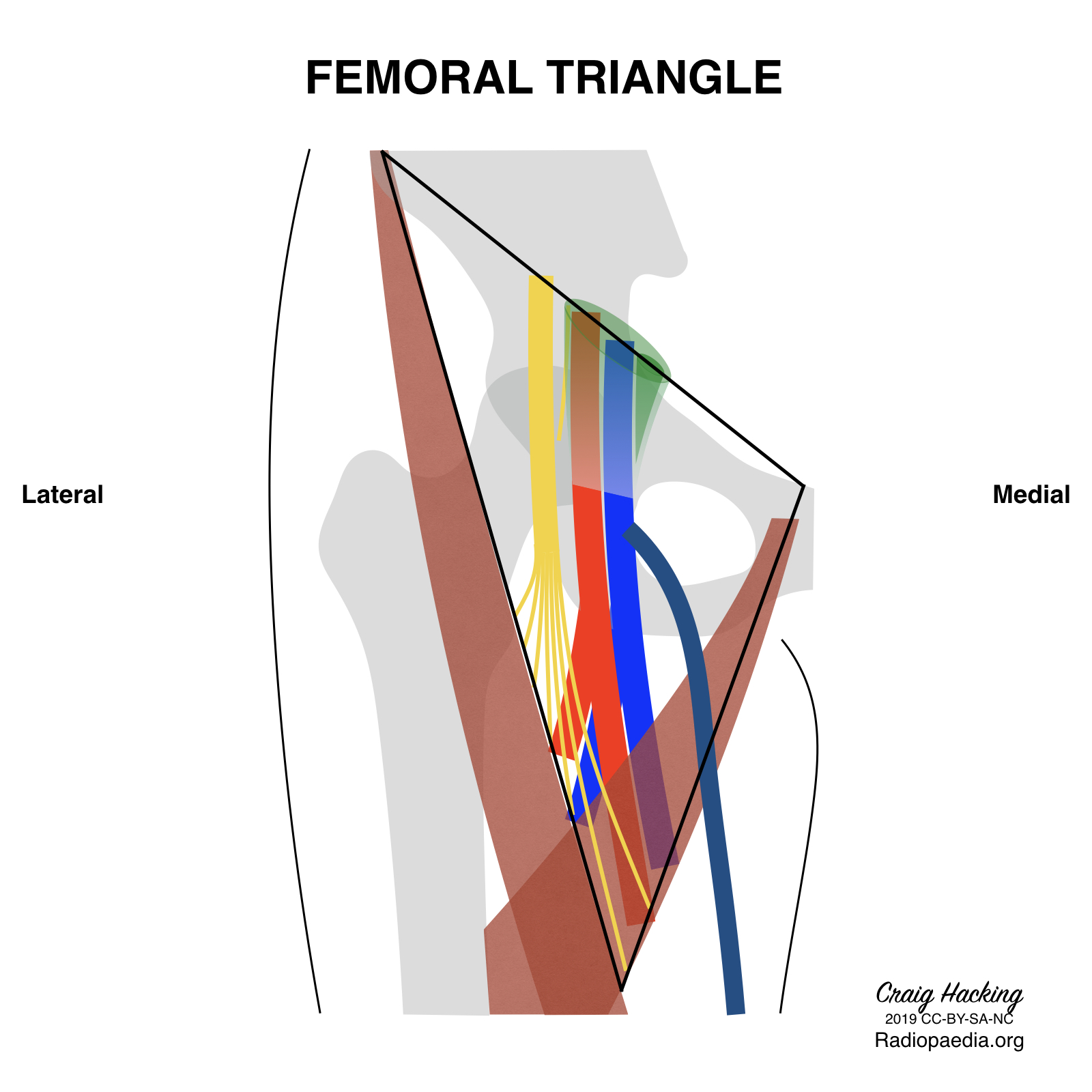 Radiopaedia - Drawing Contents and boundaries of the femoral triangle ...