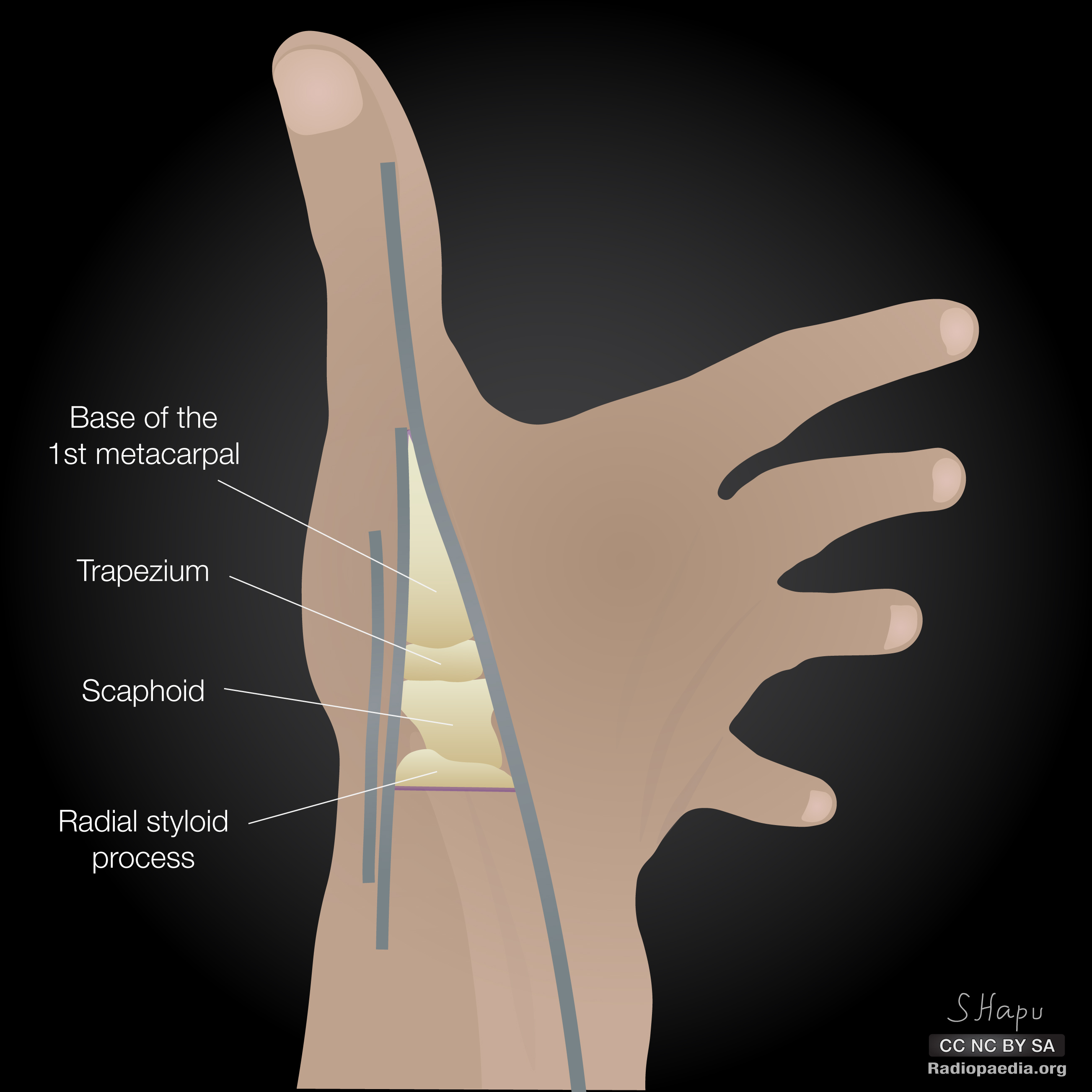 Radiopaedia - Drawing Anatomical snuff box: superficial bones - English ...
