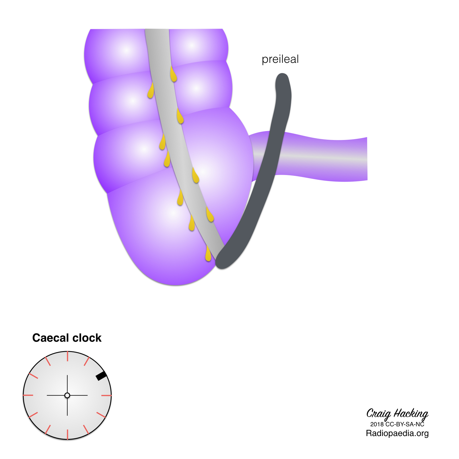 Radiopaedia - Drawing Preileal appendix position - English labels ...