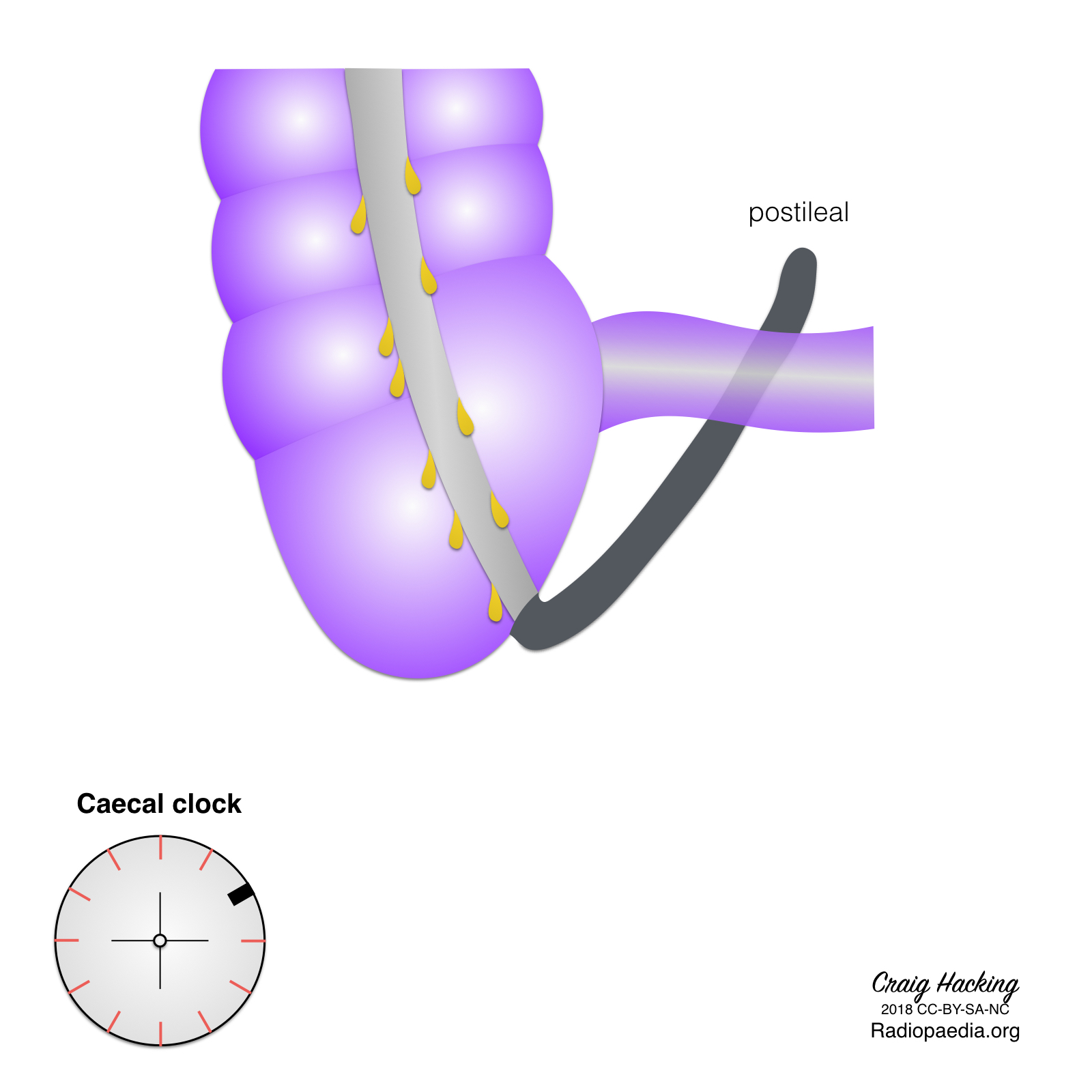 Radiopaedia - Drawing Postileal appendix position - English labels ...