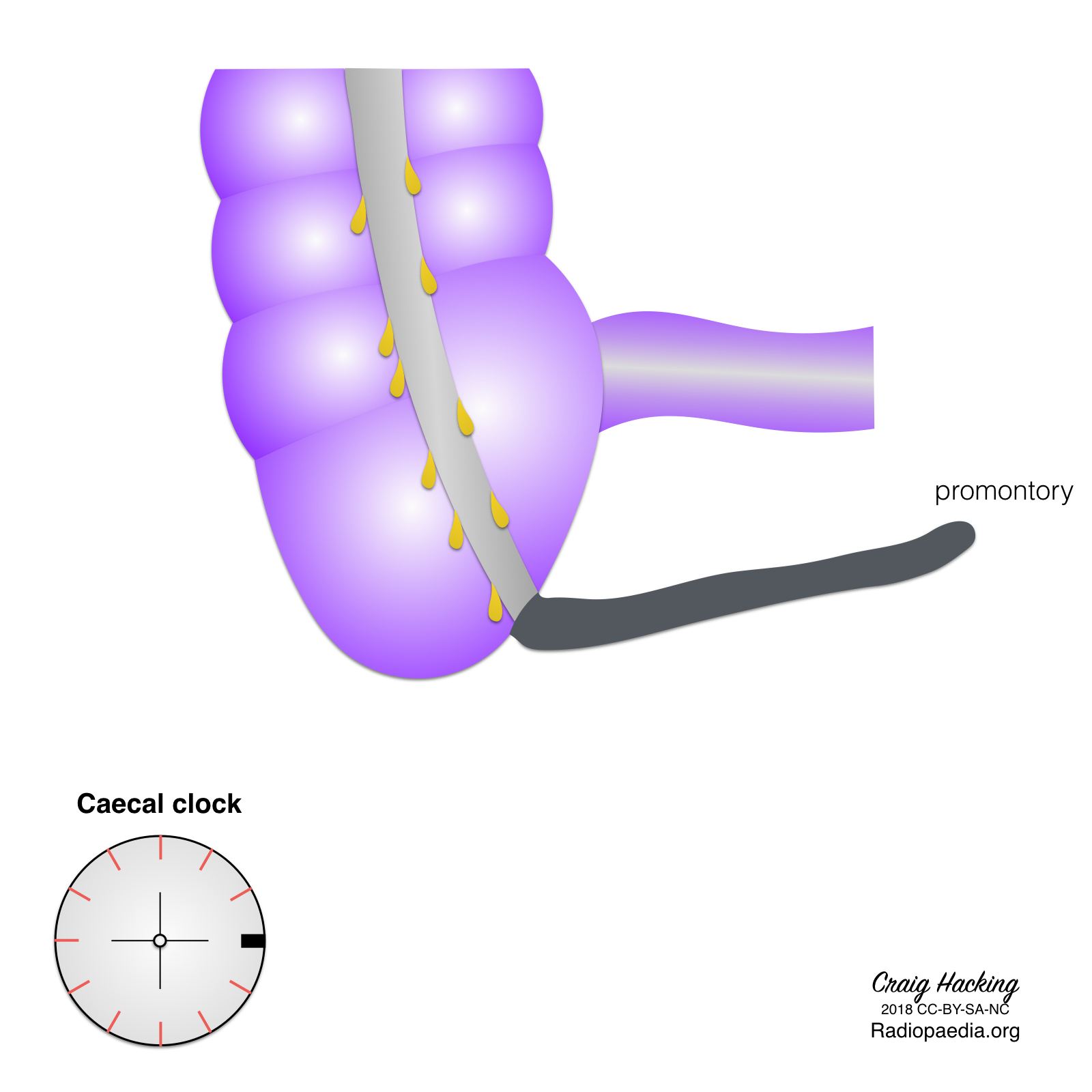 Radiopaedia - Drawing Promontory appendix position - English labels ...