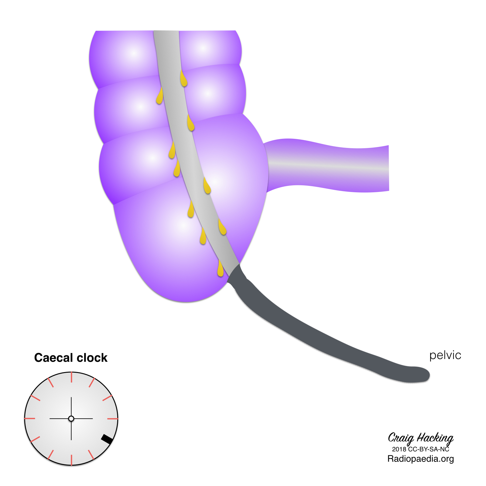 Radiopaedia - Drawing Pelvic appendix position - English labels ...