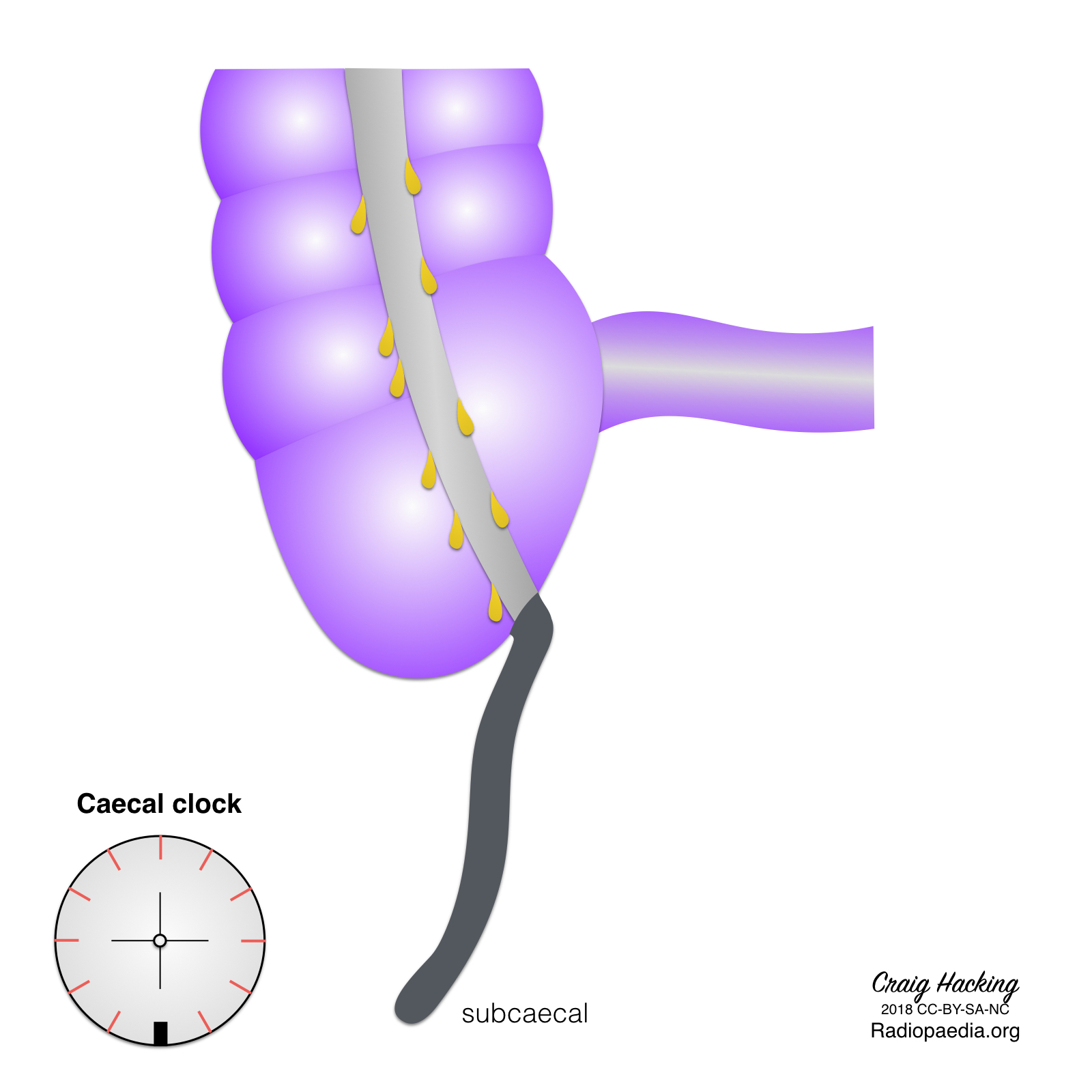 Radiopaedia - Drawing Subcaecal appendix position - English labels ...