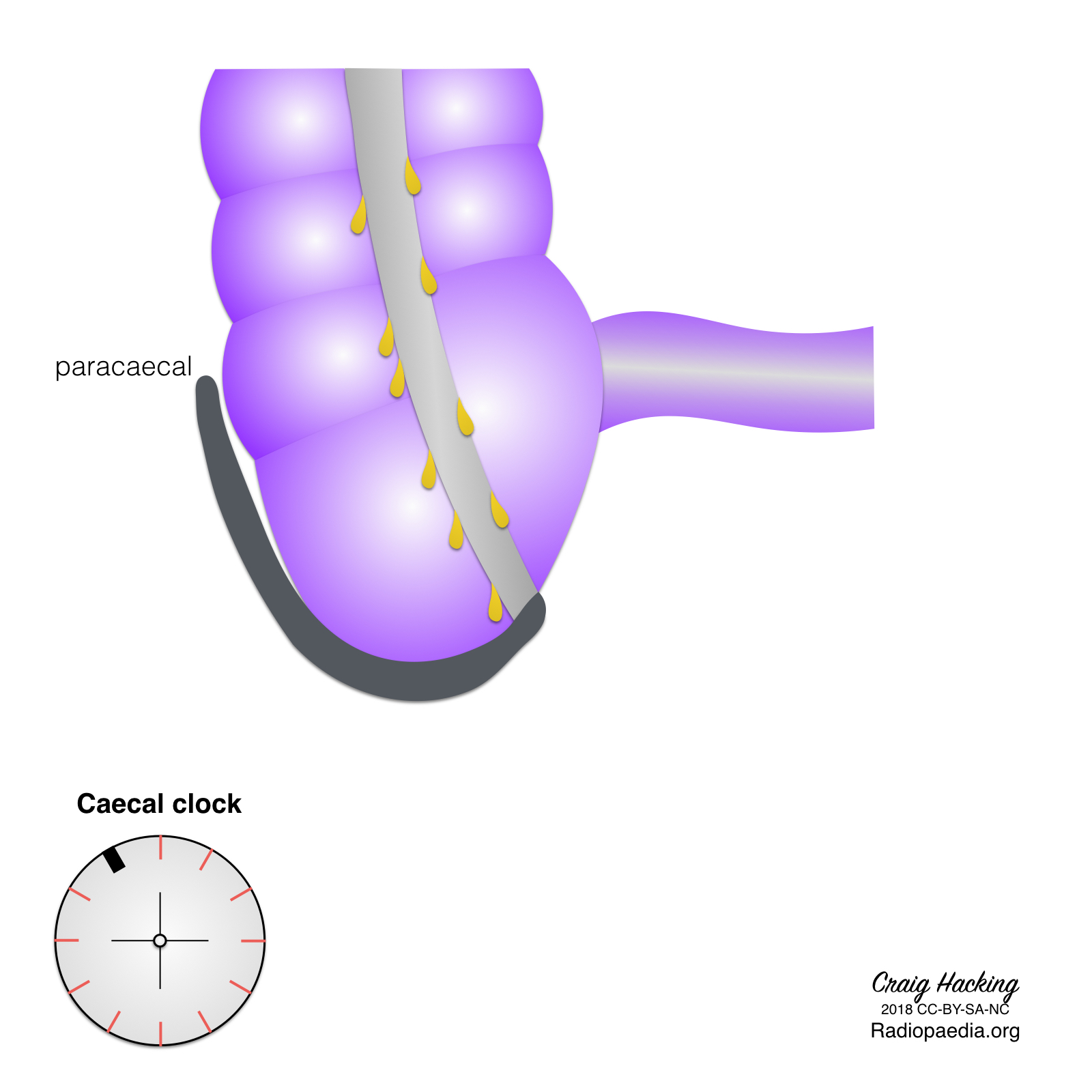 Radiopaedia - Drawing Paracaecal appendix position - English labels ...