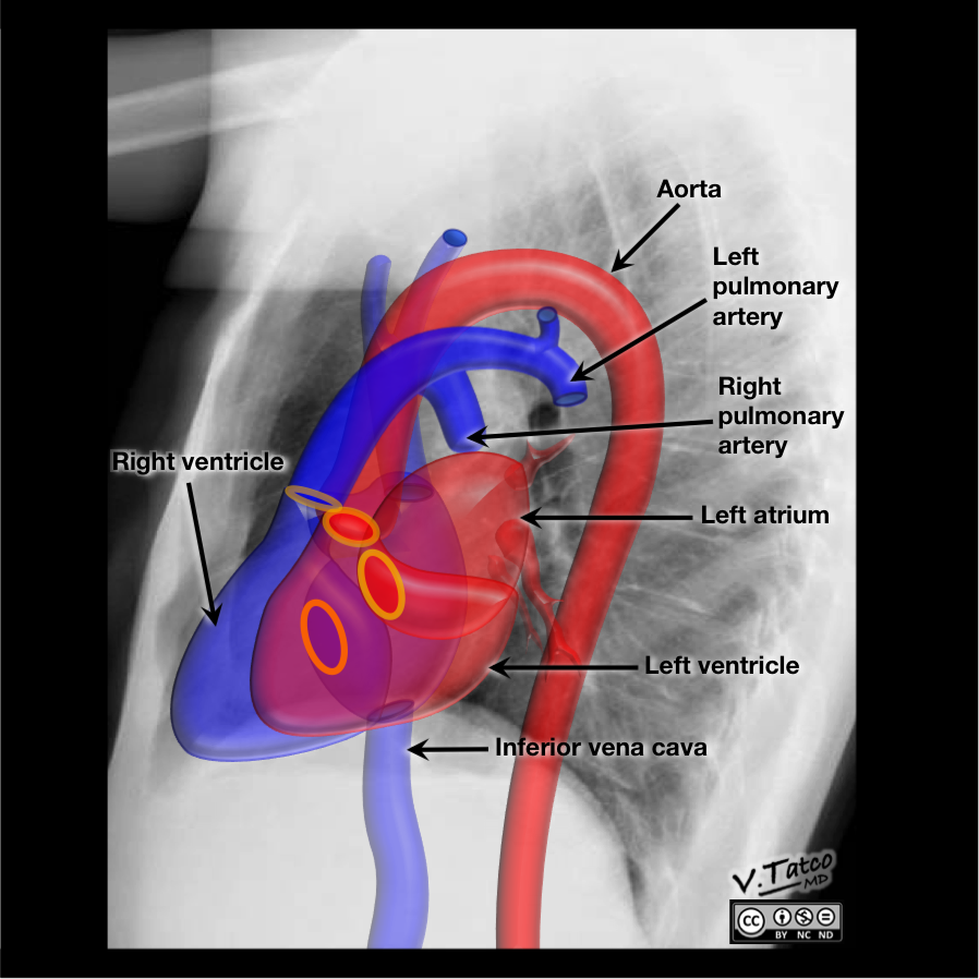 Radiopaedia - Drawing/X-ray Position of heart and great vessels in ...