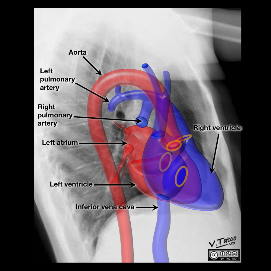 Radiopaedia - Drawing/X-ray Position of heart and great vessels in ...