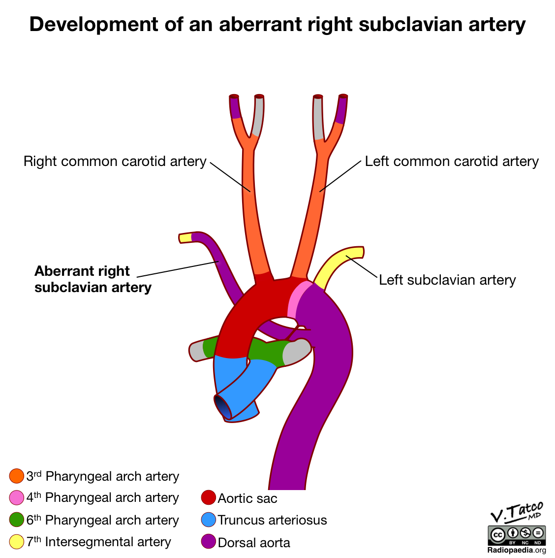Left Subclavian Artery