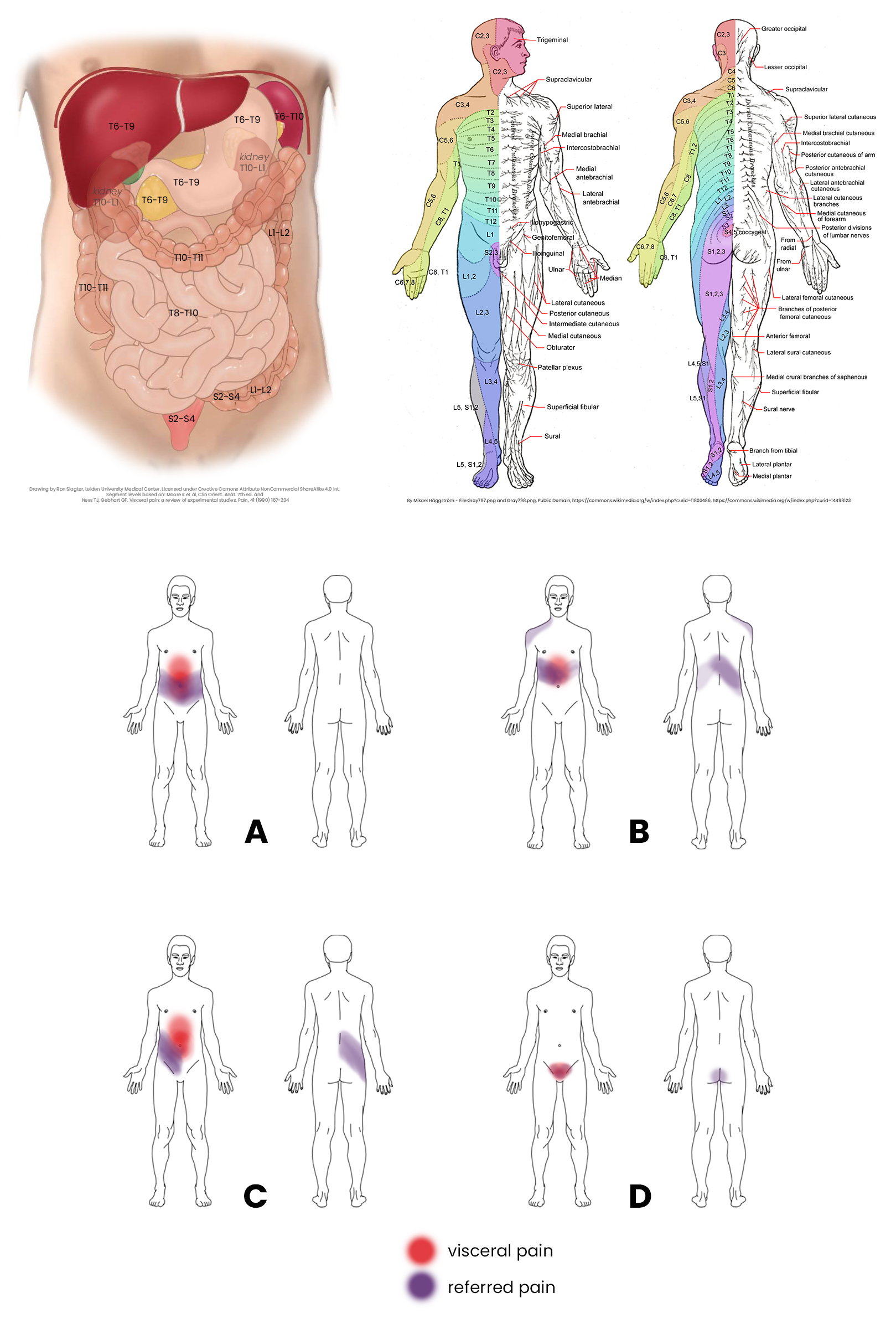 Visc-sens-Nl 14 pijn-uitstralings-regio's - cholecystitis | AnatomyTOOL