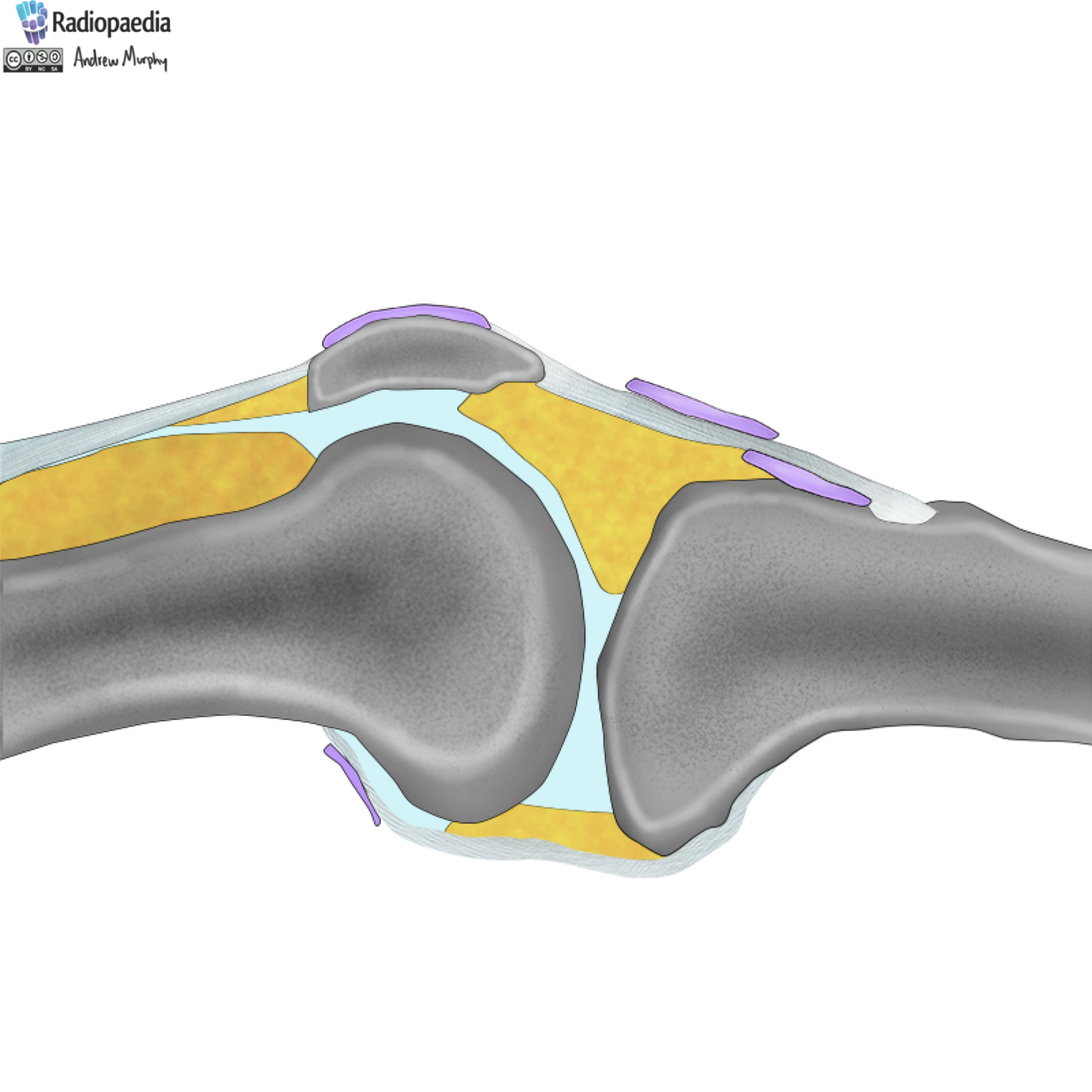 Radiopaedia - Drawing Fat pads and bursae of the knee - no labels ...
