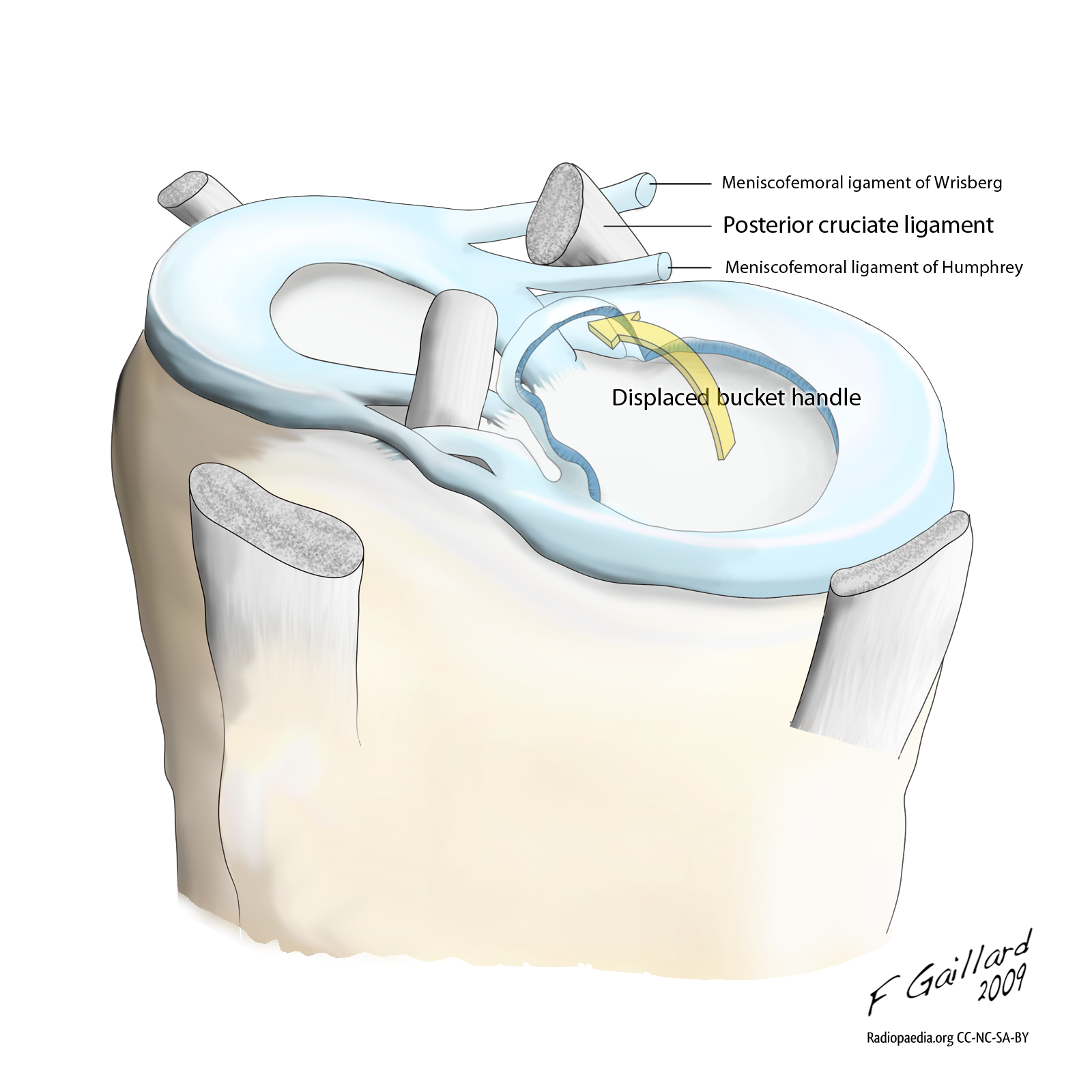 Radiopaedia - Drawing Anatomy of the menisci and displaced buckle ...