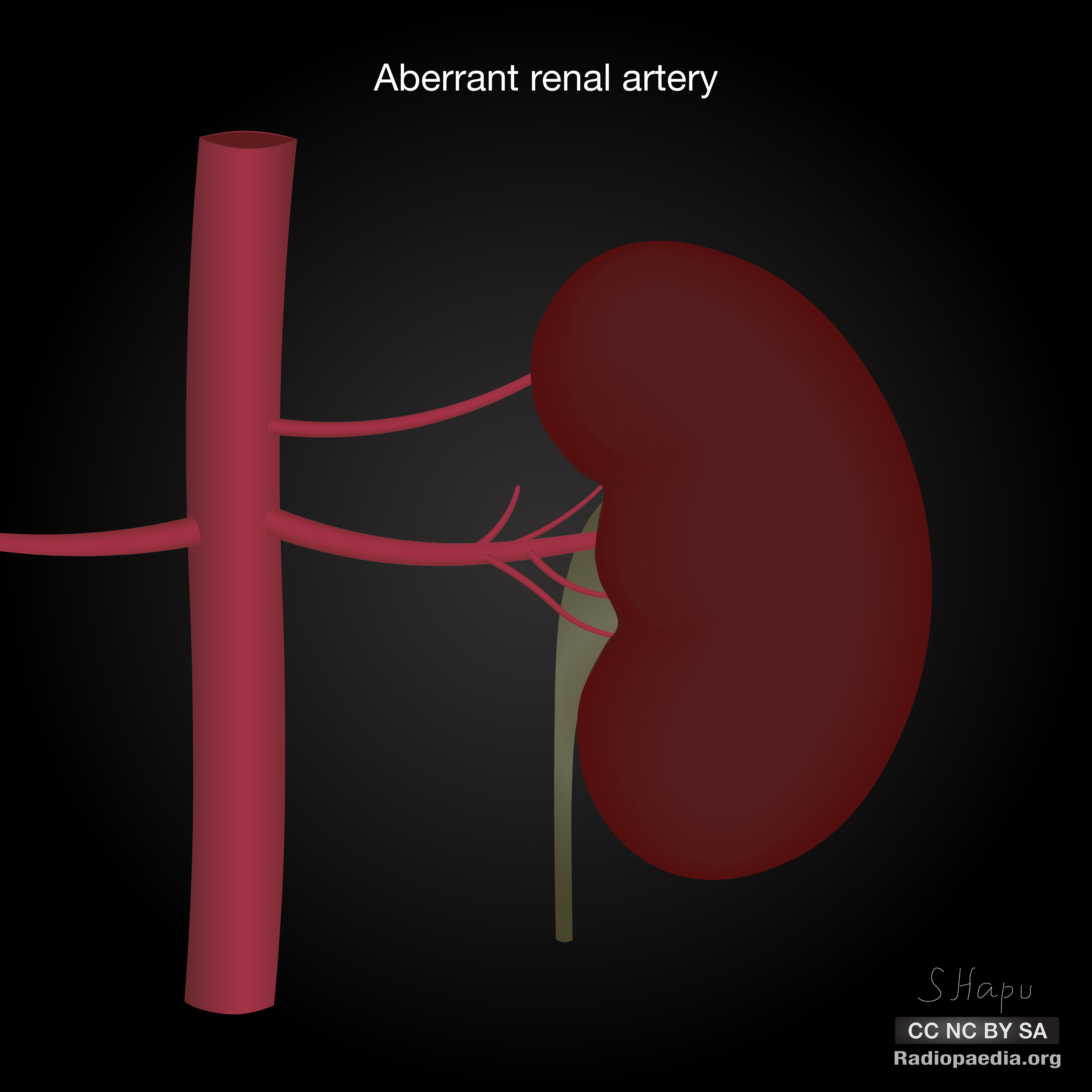 Radiopaedia - Drawing Aberrant renal artery - no labels | AnatomyTOOL