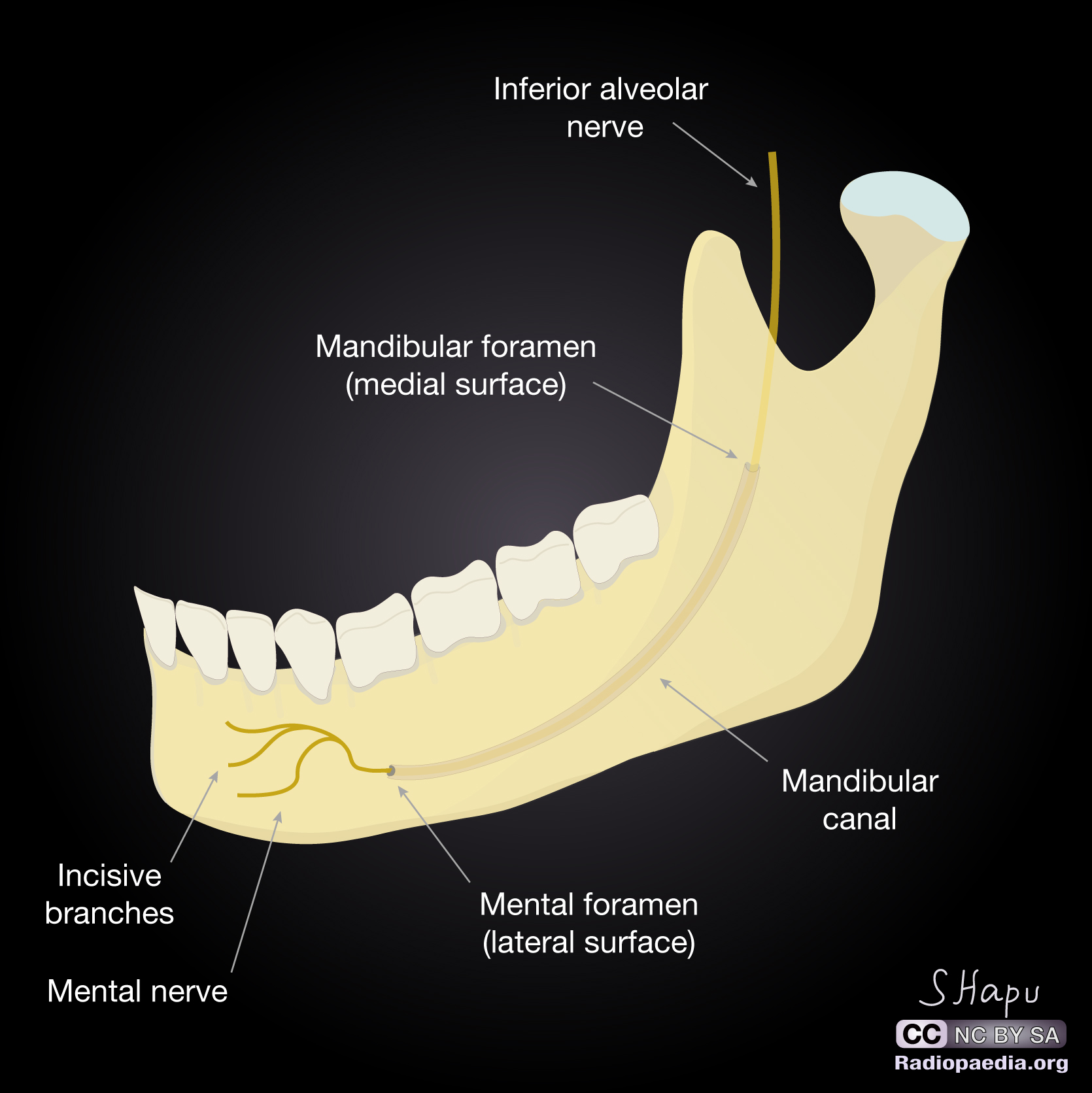 Radiopaedia - Drawing Inferior alveolar nerve of mandibular nerve ...