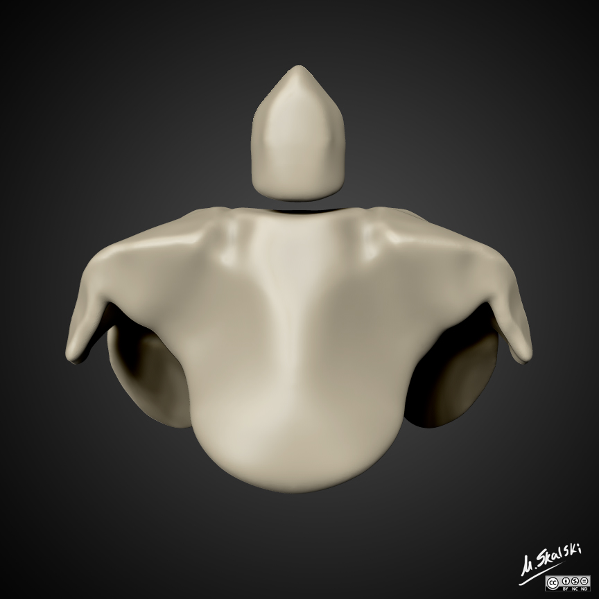 Radiopaedia - Drawing Variant of dens axis: os odontoideum - no labels ...