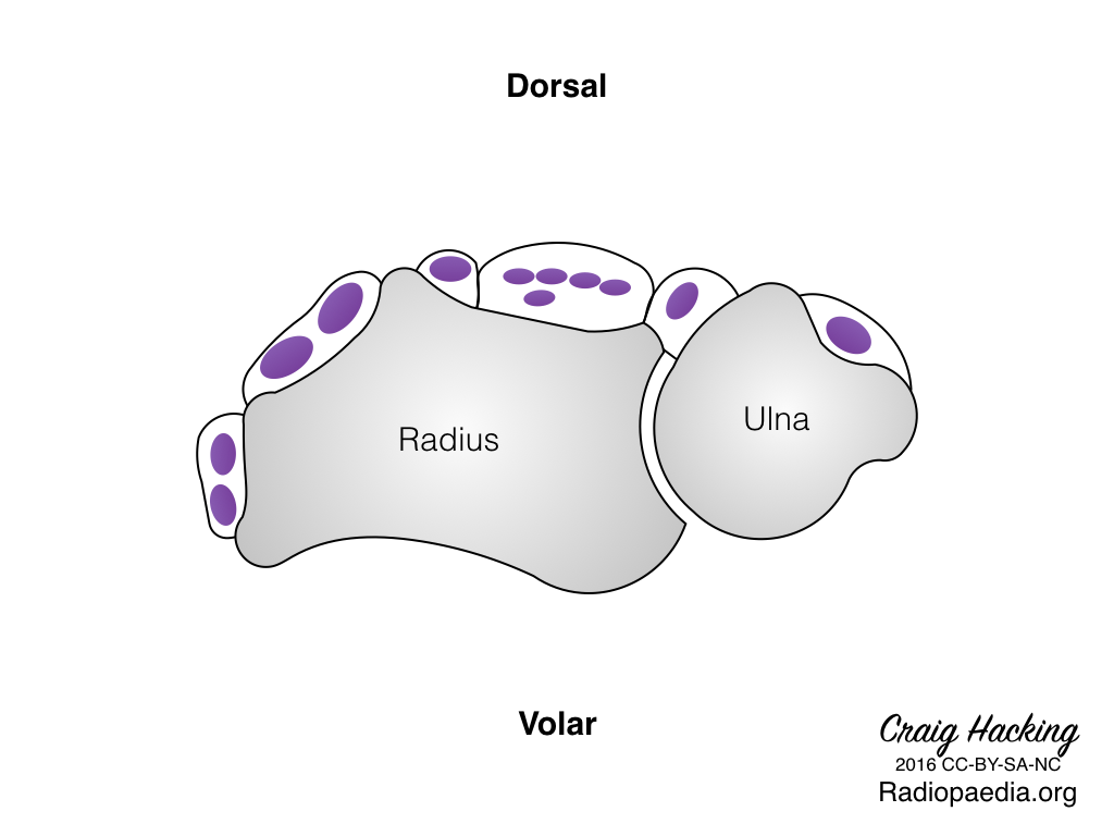 Radiopaedia - Drawing Wrist extensor retinaculum compartments - no ...